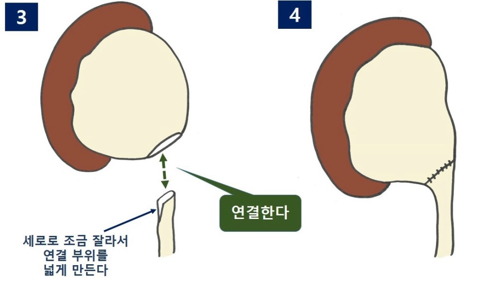 신우성형술 신우요관이행부협착증 수술 네이버 블로그