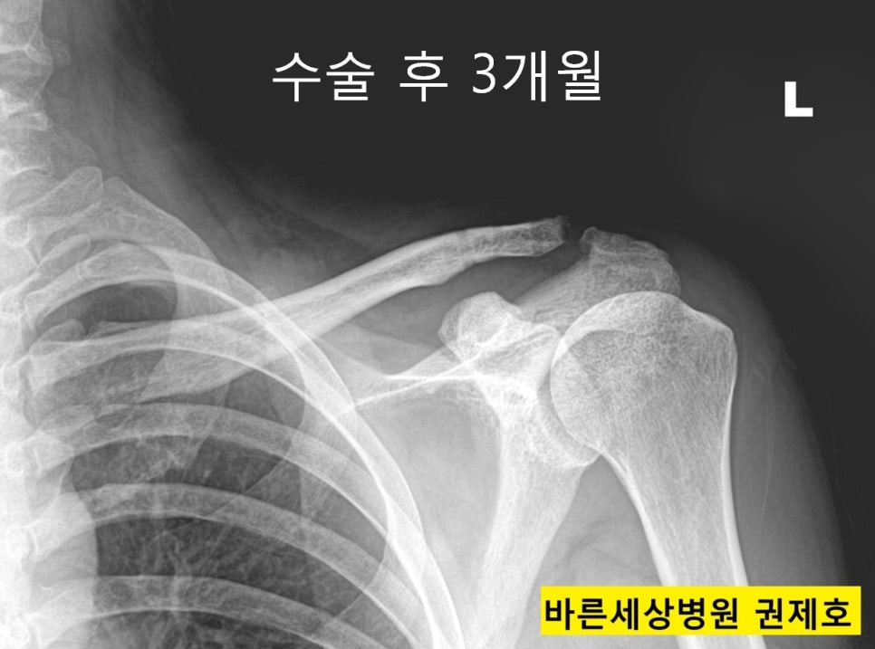 어깨 탈구 및 쇄골 돌출 치료 예 바른세상병원 권제호 네이버 블로그
