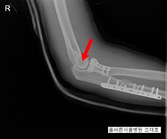 몬테지아 골절monteggia Fracture 척골 골절과 동반된 요골두의 골절 탈구 에서의 관혈적 정복술 및 내고정술