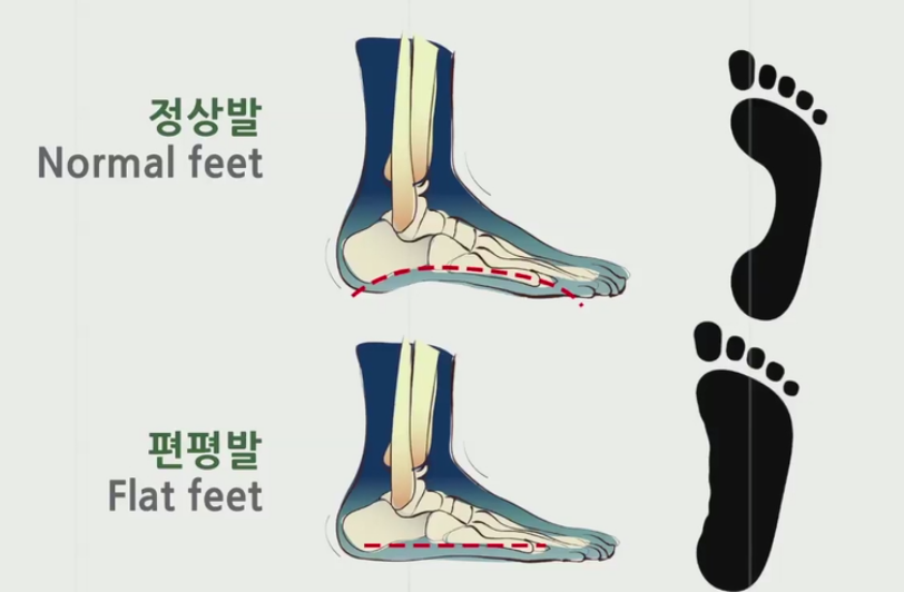 인체해부학 발허리뼈 발가락뼈 발바닥활 쉽게 파헤치기 네이버 블로그