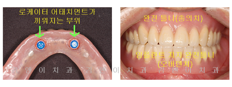 덴티움 임플란트와 로케이터 어태치먼트를 이용한 아래턱 임플란트 지지 완전틀니오버덴쳐 네이버 블로그