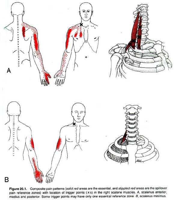 사각근 목디스크 아니고 사각근 증후군 손저림 어깨통증 흉곽출구증후군 네이버 블로그