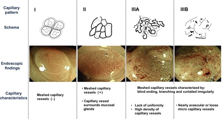 Narrow band imaging (NBI) magnifying classification for colon tumors ...