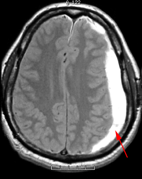 급성 경막하출혈) SDH ; Acute Subdural Hemorrhage 정의, 증상, 진단, 치료 : 네이버 블로그