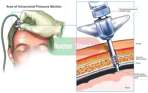 두개내압 상승(increased intracranial pressure, IICP) : 네이버 블로그