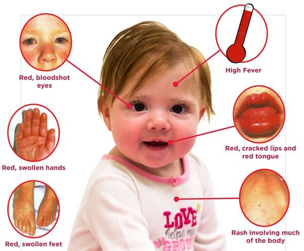 가와사키병 (Kawasaki disease, Mucocutaneous lymph node syndrome), 양쪽결막충혈 ...